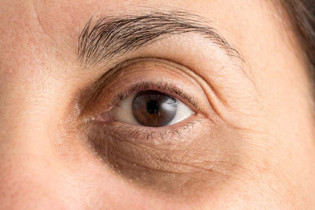 Why Poor Sleep Causes Puffy Eyes & Dark Circles Explained